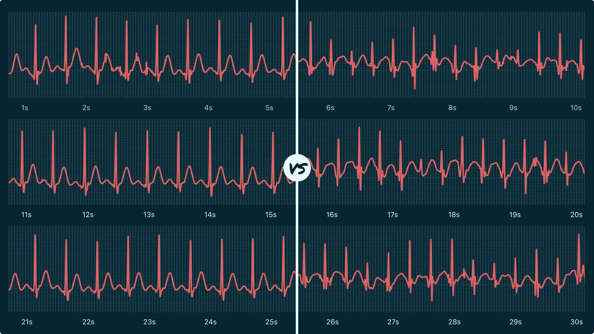 Sinus Tachycardia Vs Supraventricular Tachycardia Sustained On Your
